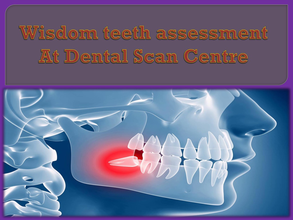 PPT - Wisdom teeth assessment At Dental Scan Centre PowerPoint ...