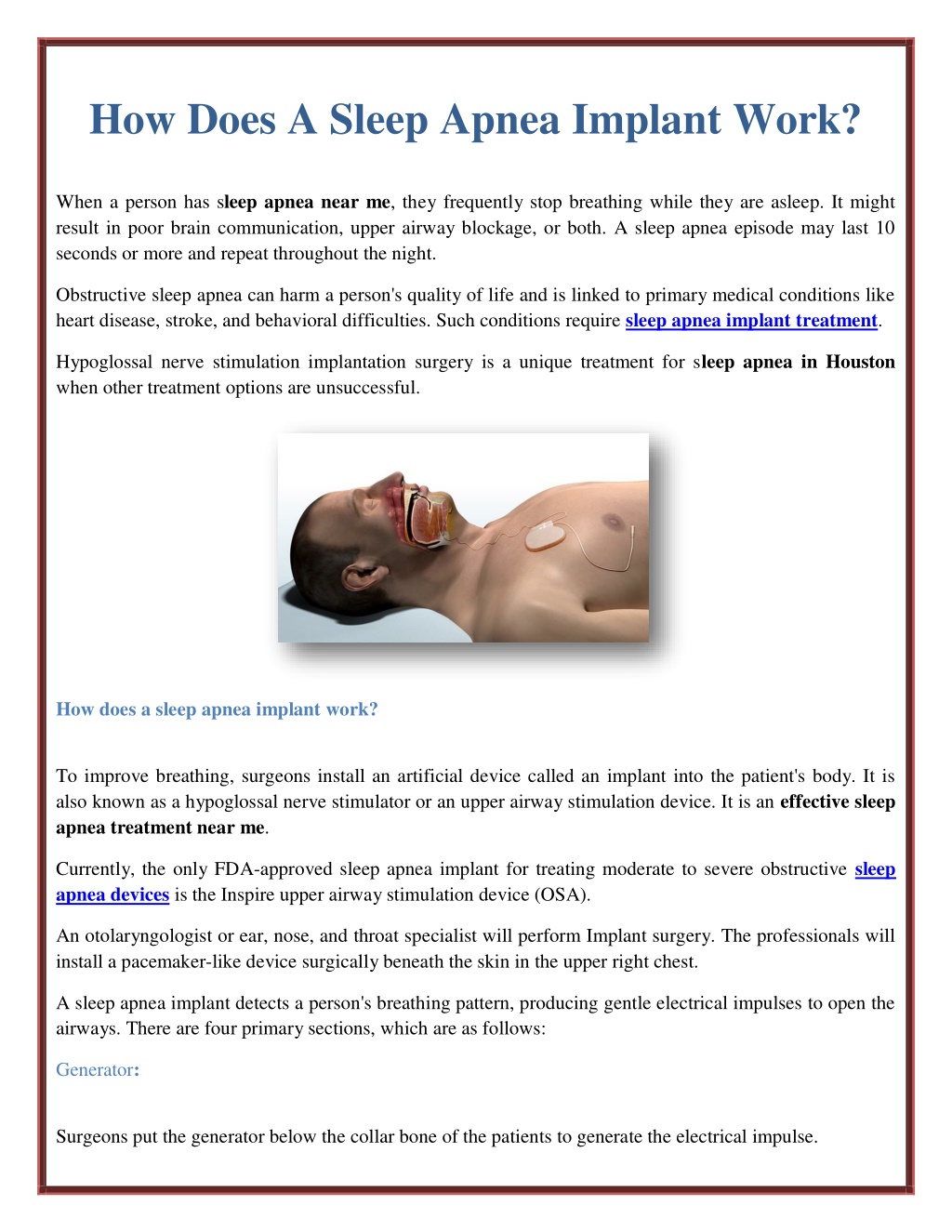 PPT - How Does A Sleep Apnea Implant Work? PowerPoint Presentation ...