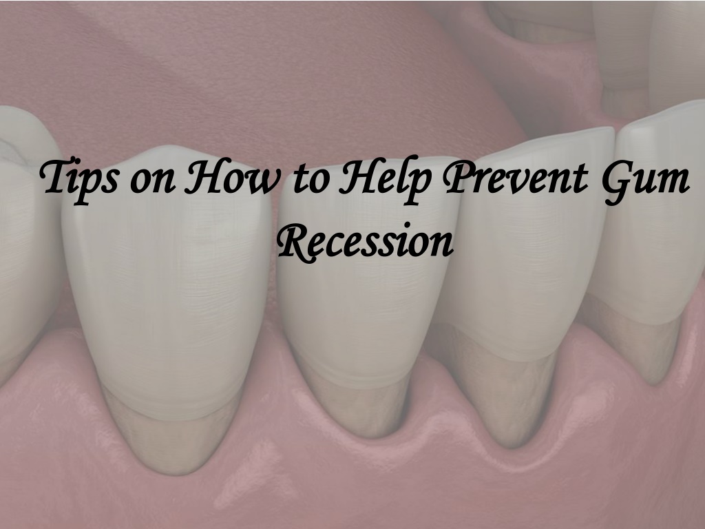 PPT - Tips on How to Help Prevent Gum Recession PowerPoint Presentation ...