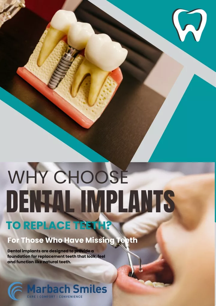 PPT - WHY CHOOSE DENTAL IMPLANTS TO REPLACE TEETH PowerPoint ...