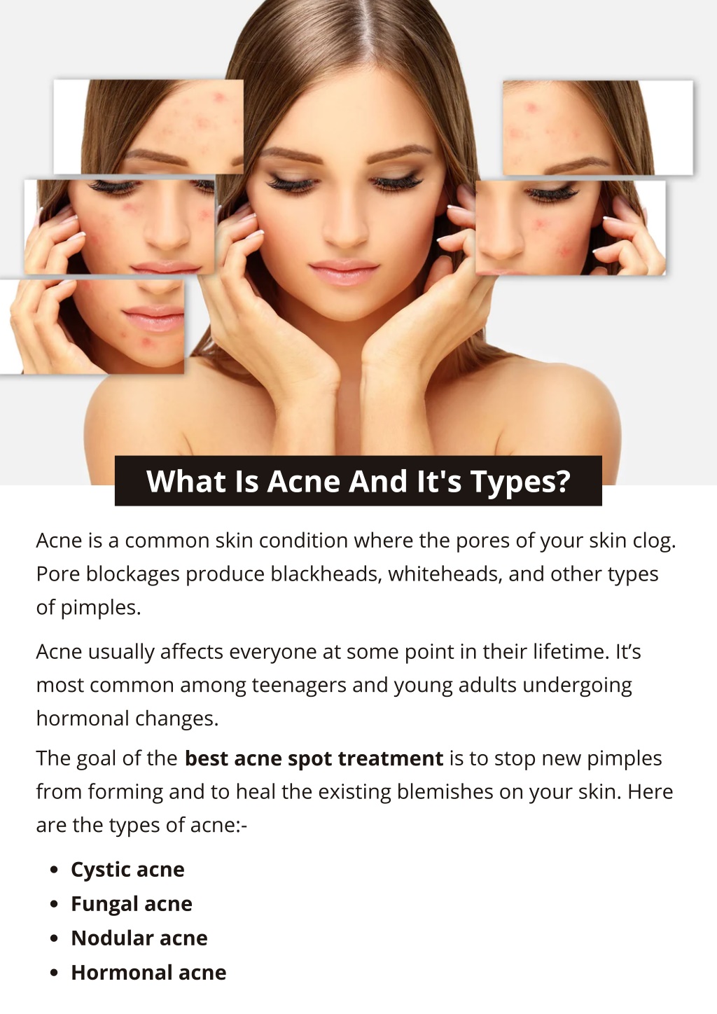 PPT - What Is Acne And It's Types PowerPoint Presentation, free download - ID:11944757